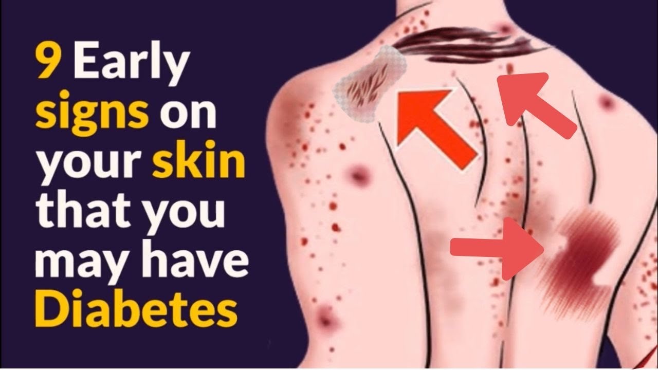 9 Early signs on your skin that you may have diabetes - YouTube