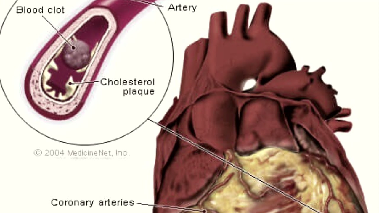 Aims of Treatment of Heart attack/Coronary artery disease? - YouTube