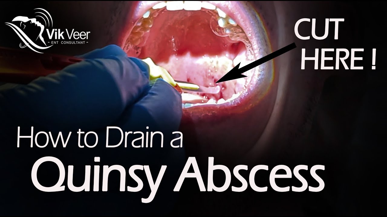 How to Drain an Quinsy ( Abscess in your Throat ! ) +18 content - YouTube
