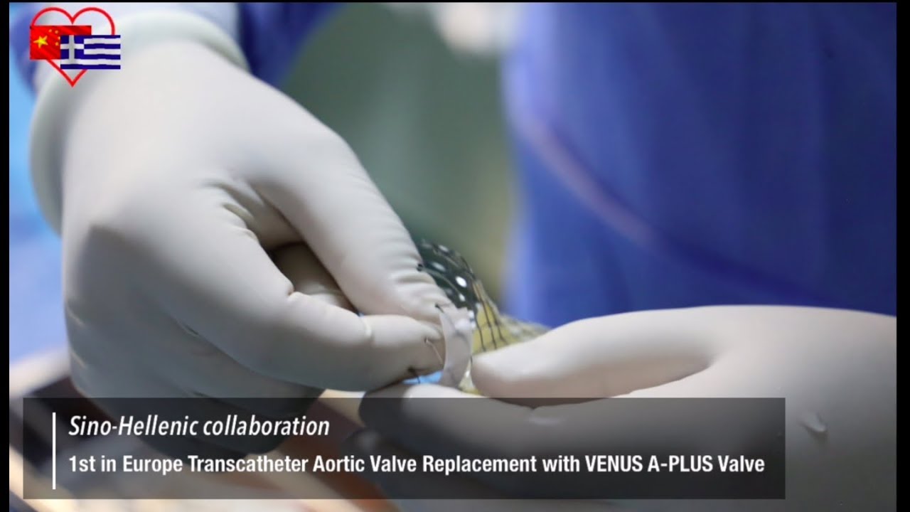 Transcatheter Aortic Valve Replacement with VENUS A PLUS Valve - YouTube