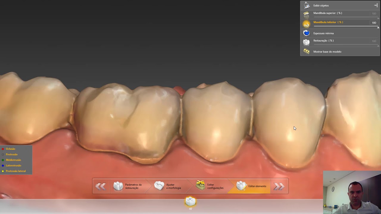 CEREC e INLAB: ARTICULADOR VIRTUAL - YouTube