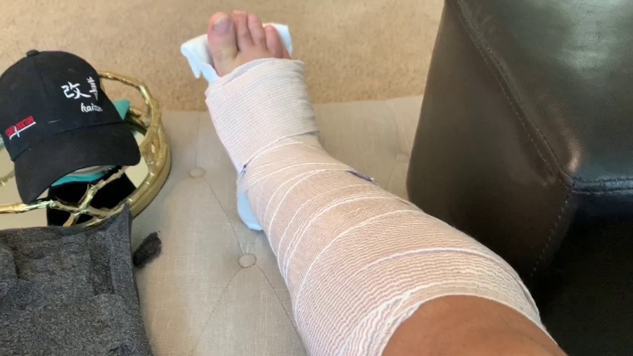 Broken Leg Improvements - YouTube