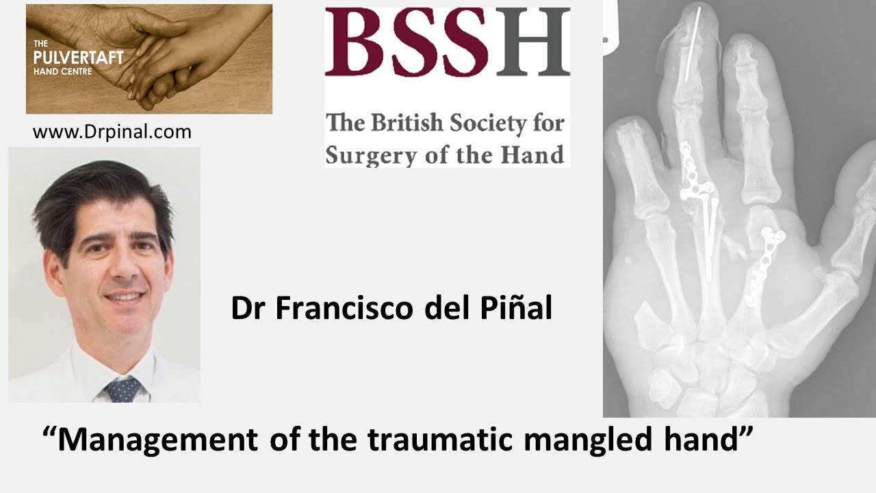 Management of the mangled hand 2nd Ed by Dr Paco del Pinal - YouTube