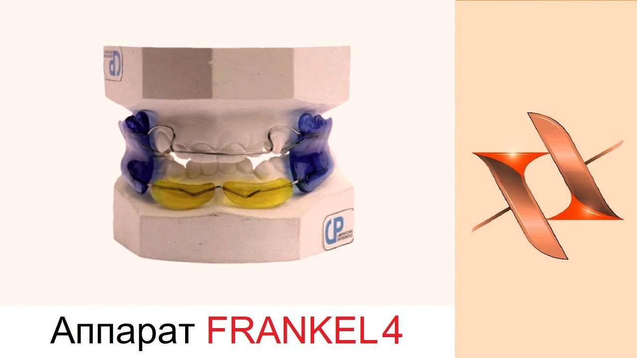 Френкель 4 (Frankel 4) - ортодонтический регулятор функций. - YouTube