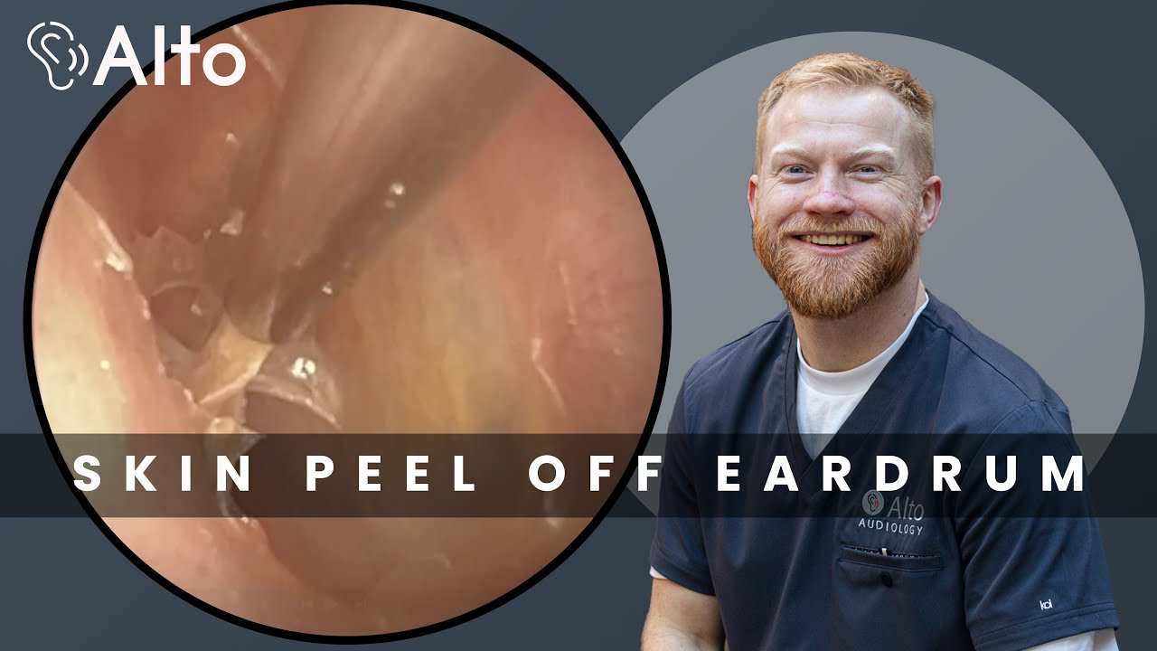 The Most DELICATE Ear Wax Removal We Do - Skin Peels Off the Eardrum ...