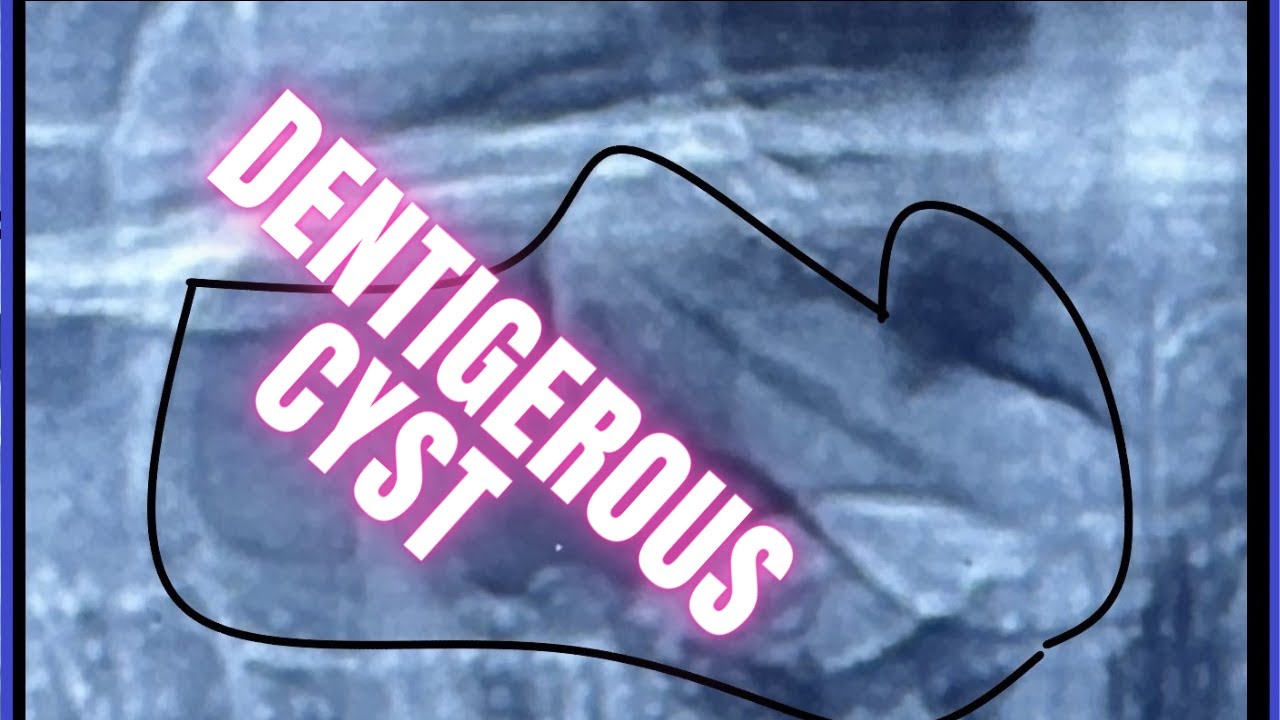EXTRACTION OF IMPACTED MAXILLARY CANINE AND SUPERNUMERARY TEETH WITH ...