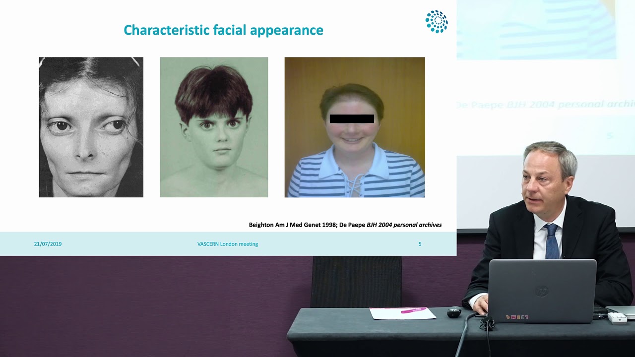 Clinical Features and Diagnostic criteria of vascular Ehlers-Danlos ...