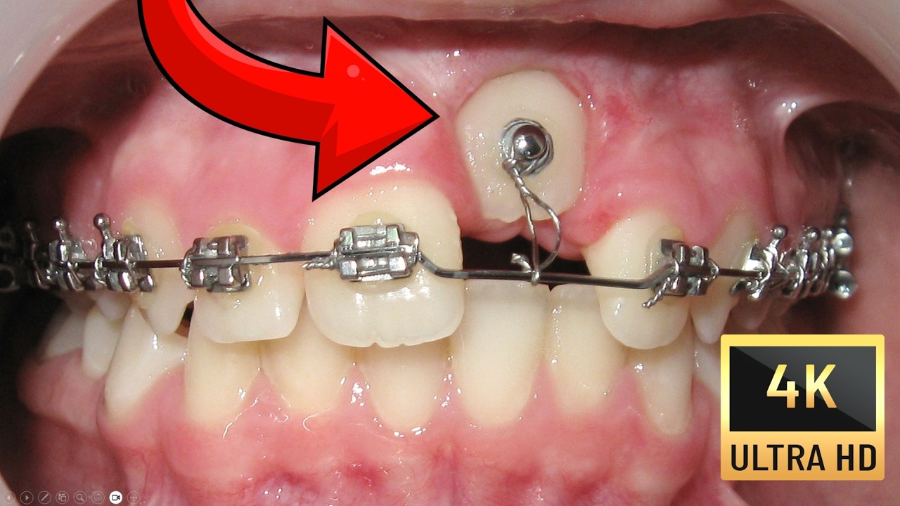 🔥 Unexpected INCISOR impaction - The Magic of Orthodontics 💖Braces time ...