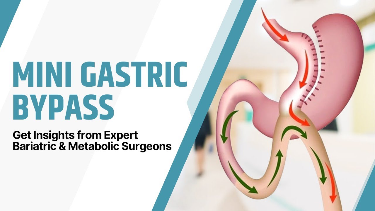 Mini Gastric Bypass (MGB) - Diet, Precautions & Complications | Mini ...