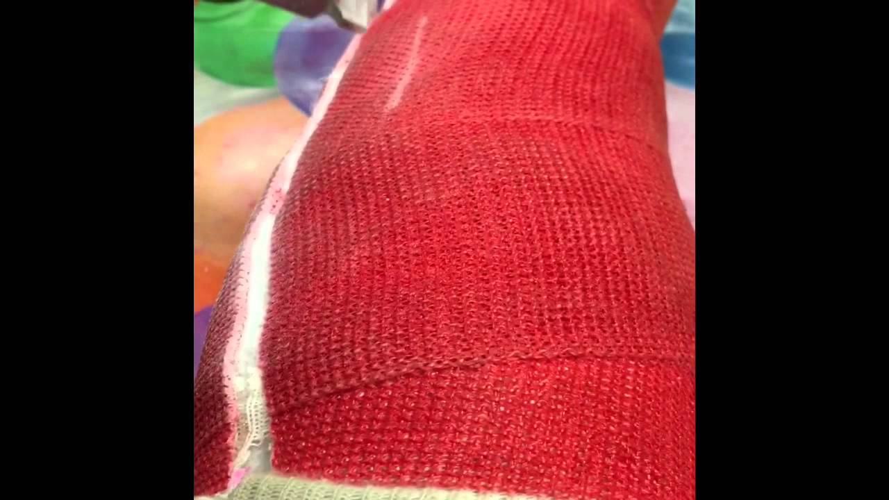 Removing a plaster cast - YouTube