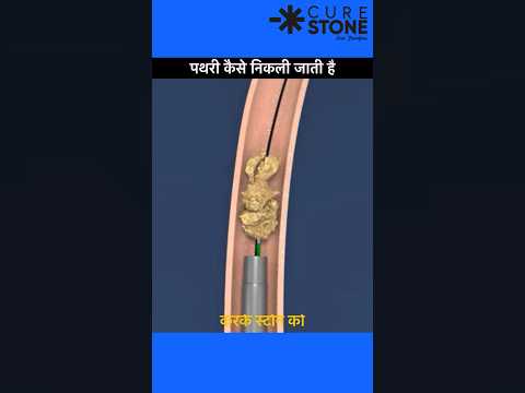 Kidney stone treatment | RIRS Ureteroscopy | Ureteric Stone removal | Laser treatment #shorts