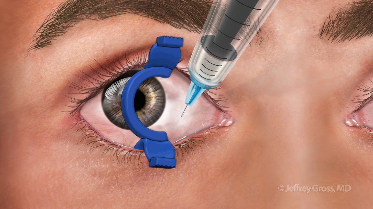 The Speculet™ - Revolutionizing Patient Comfort for Intravitreal ...