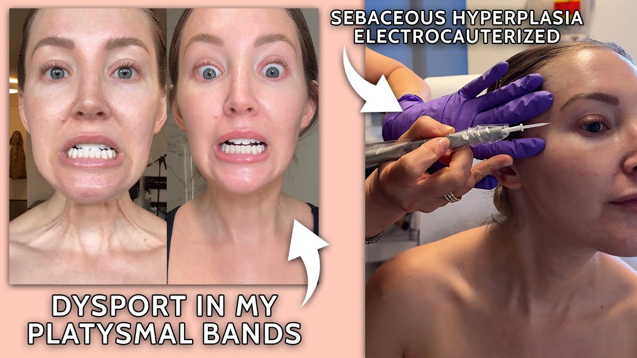 Dysport in my Platysmal Bands and my Sebaceous Hyperplasia ...