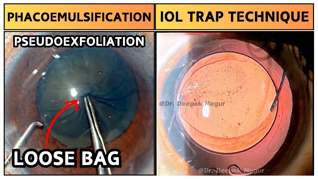Phacoemulsification - Pseudoexfoliation, Loos Bag IOL TRAP - Dr. Deepak ...