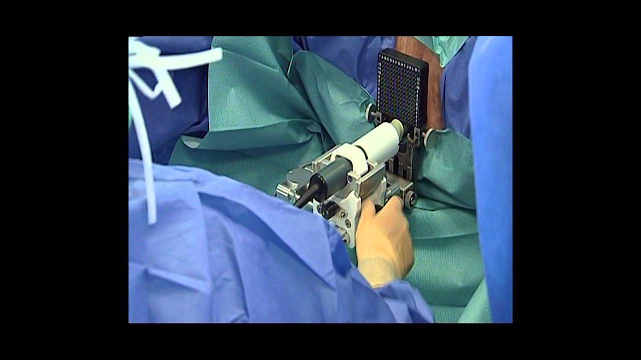 gezielte Prostatabiopsie - Eine kurze Einführung - YouTube