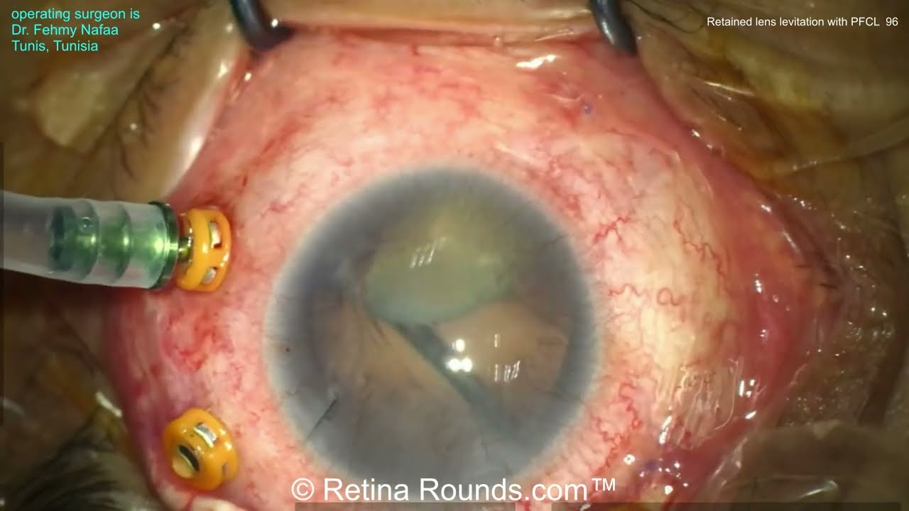 RetinaRounds™ 96: Retained Lens Levitation with PFCL - YouTube