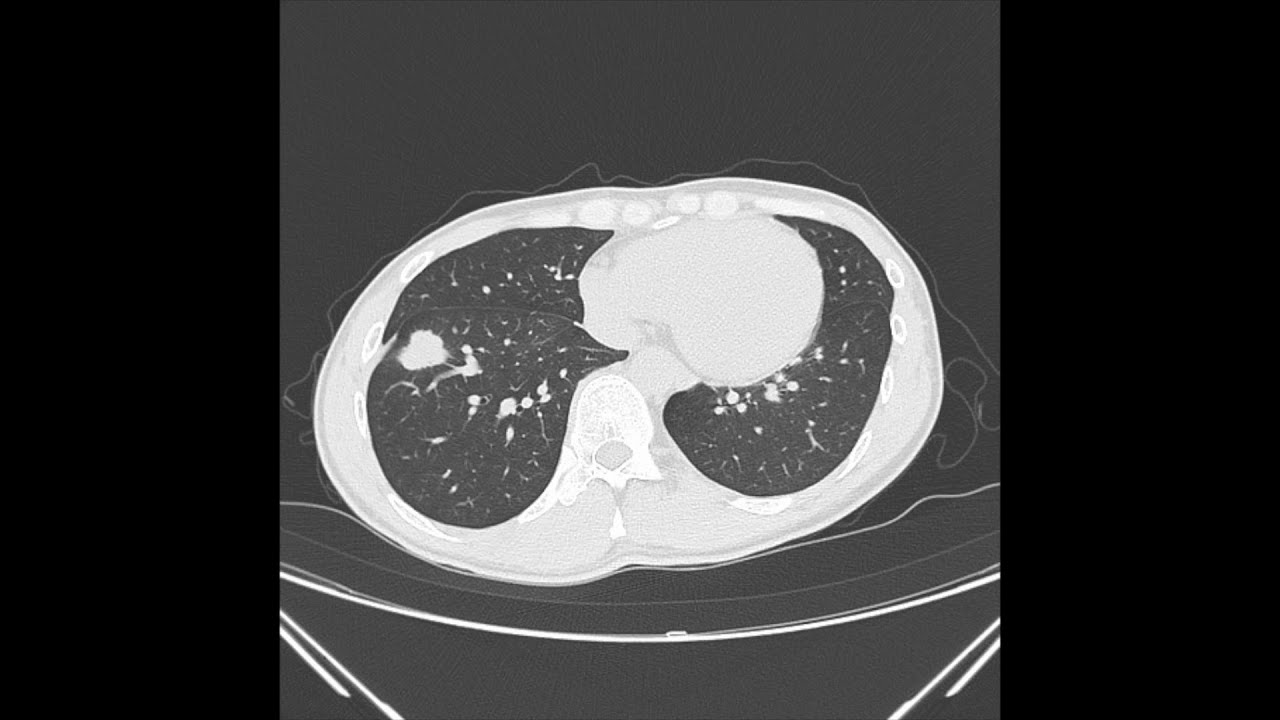 NON EDITED uniportal RATS Right lower lobectomy ND2a-2 and #12u - YouTube