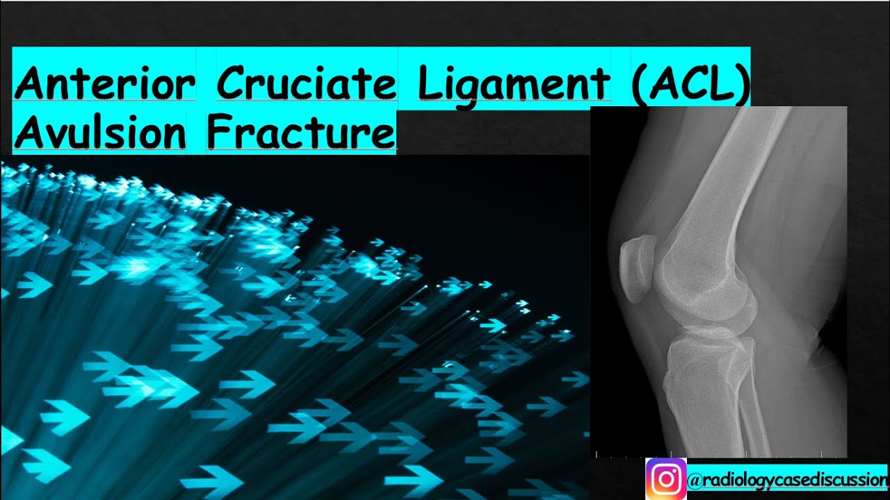 7-🦴♿️ ANTERIOR CRUCIATE LIGAMENT(ACL) AVULSION FRACTURE 🩼. MRI FINDINGS ...
