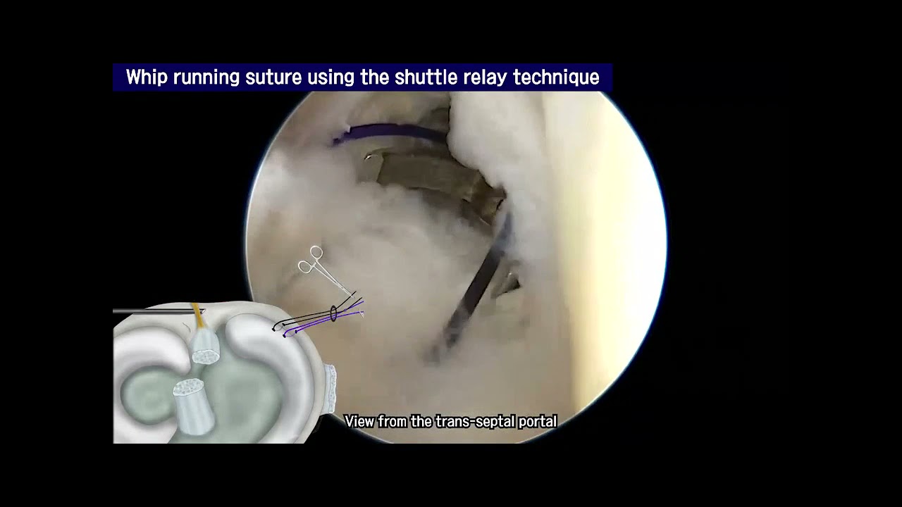 Arthroscopic Transtibial Pull-Out Repair of Medial Meniscus Posterior ...