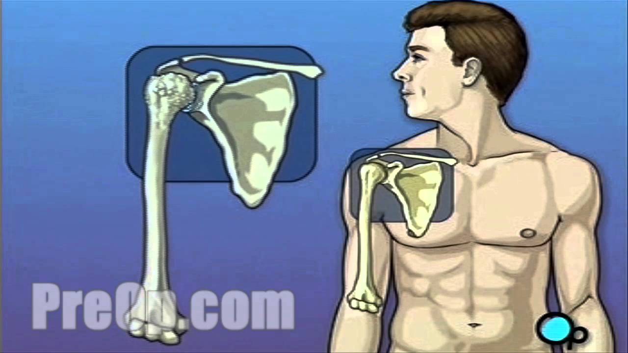 Shoulder Replacement Surgery PreOp® Patient Engagement and Education ...