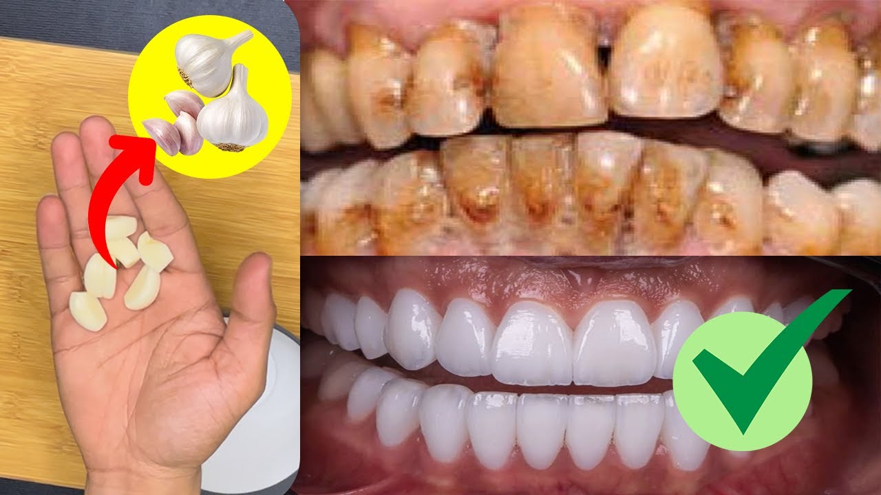 Teeth whitening naturally and effortlessly at home - YouTube