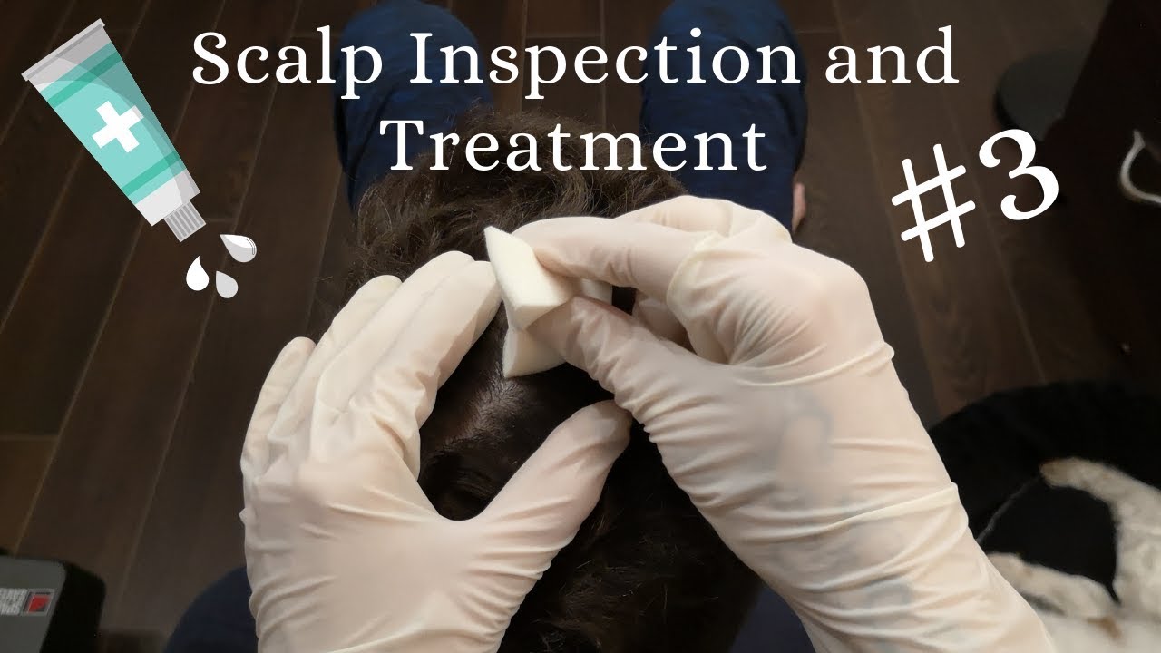 Real Person ASMR Scalp Check, Lice Check and Scalp Treatment #3 No ...