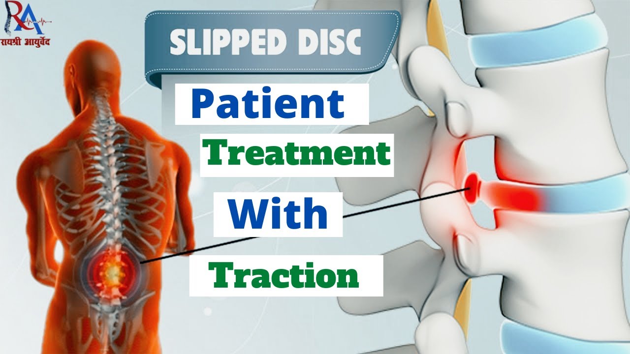 Traction For Slip Disc Patient - YouTube
