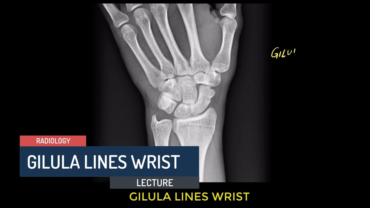 Gilula Lines Wrist - Detailed explanation - YouTube