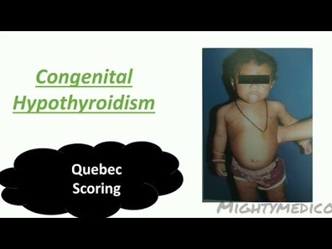 Congenital Hypothyroidism | Quebec score | Screening | Mightymedicoz ...