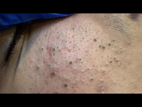 ASMR-Techniken zur Mitesserentfernung und Tiefenreinigung der Poren – für ein wohltuendes Erlebnis