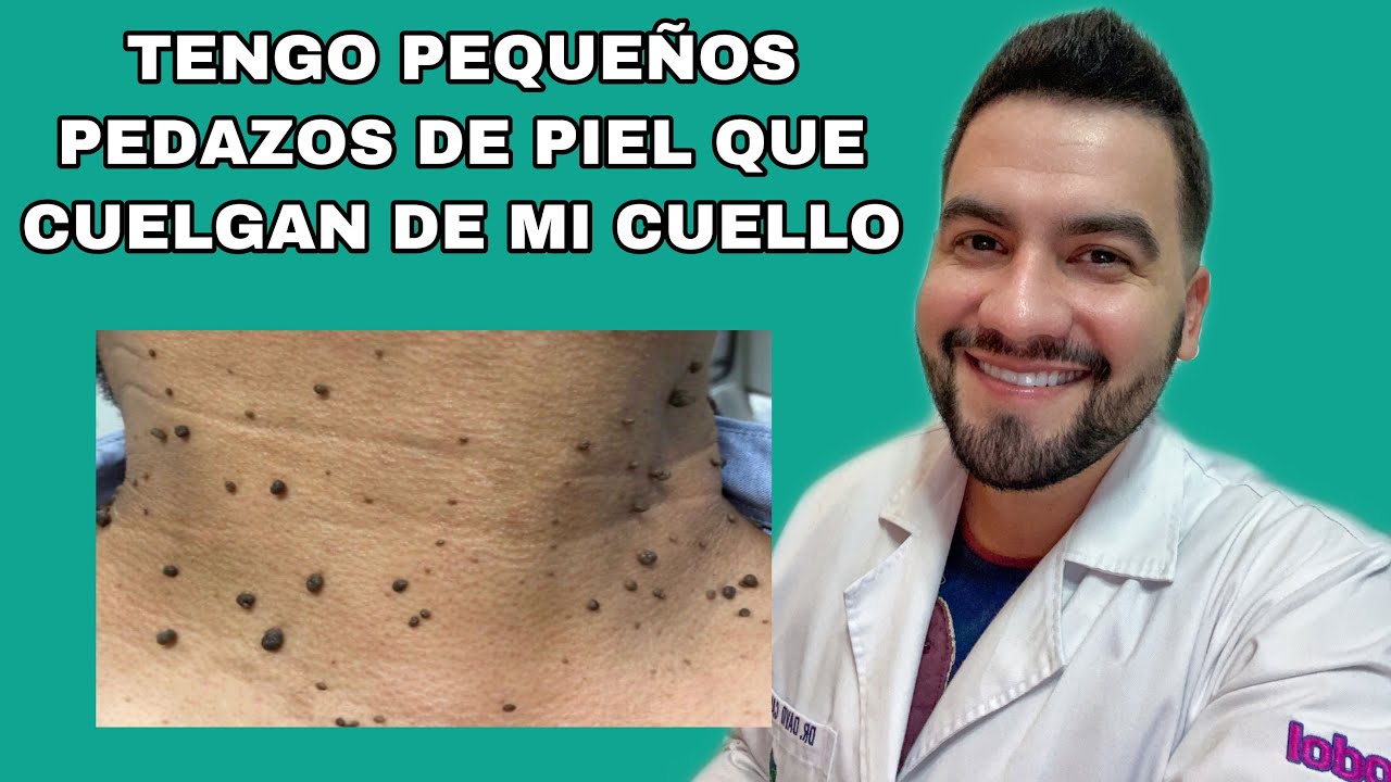 Tengo pedazos de piel colgando de mi cuello / Acrocordones / Fibromas ...