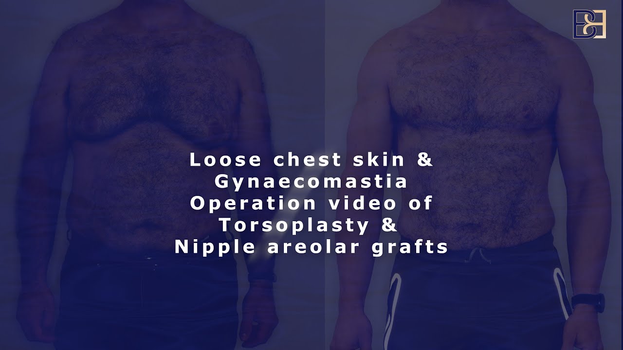 Torsoplasty operation for Gynaecomastia with excision of loose skin ...