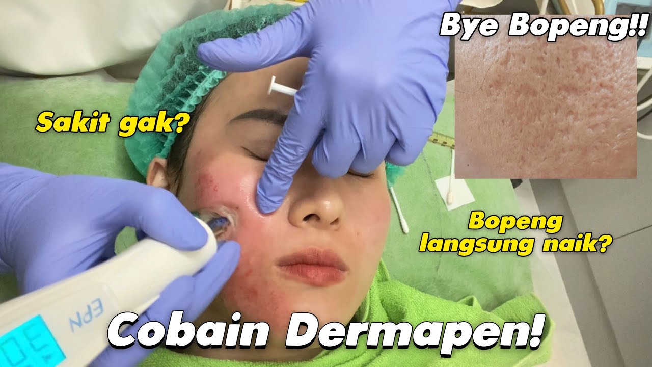 Cobain DERMAPEN! Perawatan Wajah buat bopeng dan pori2 besar.. sakit ...
