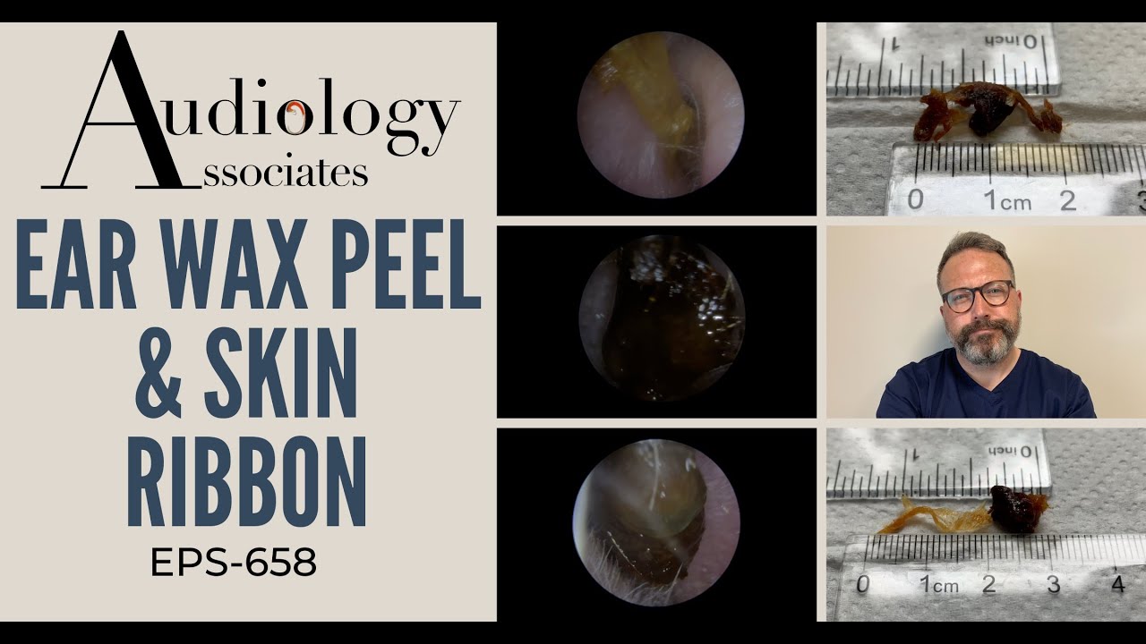 EAR WAX PEEL & SKIN RIBBON - EP658 - YouTube
