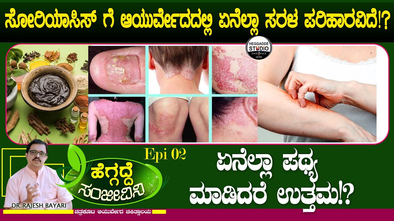 ಸೋರಿಯಾಸಿಸ್ ಗೆ ಆಯುರ್ವೇದದಲ್ಲಿ ಏನೆಲ್ಲಾ ಸರಳ ಪರಿಹಾರವಿದೆ!? | Dr. Rajesh ...