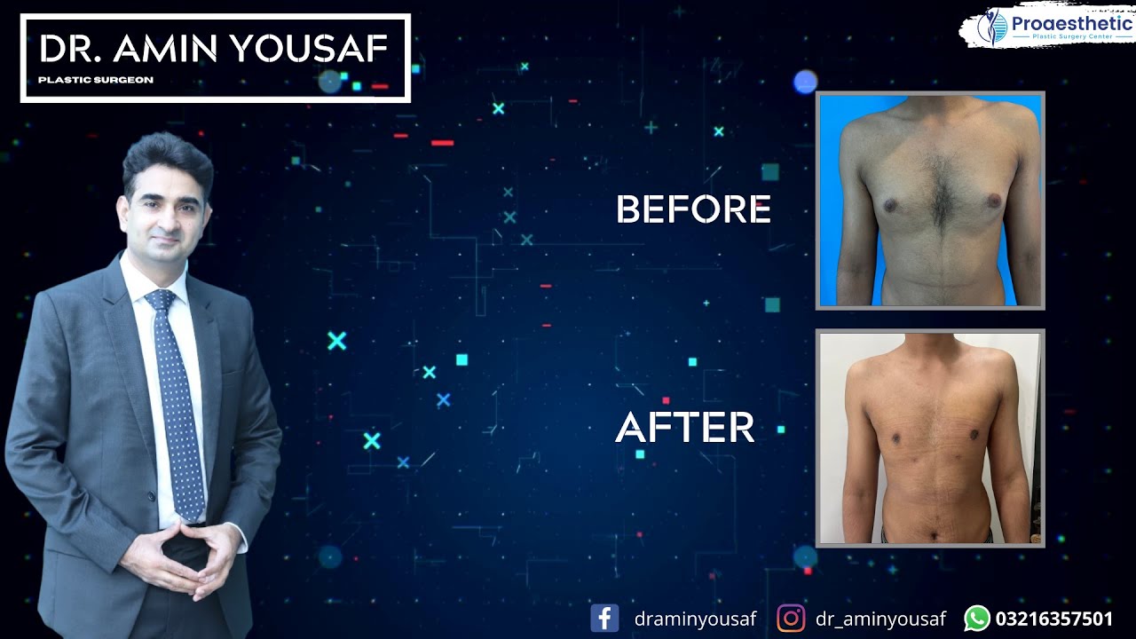 Gynecomastia Surgery Pakistan Gynecomastia Treatment Lahore