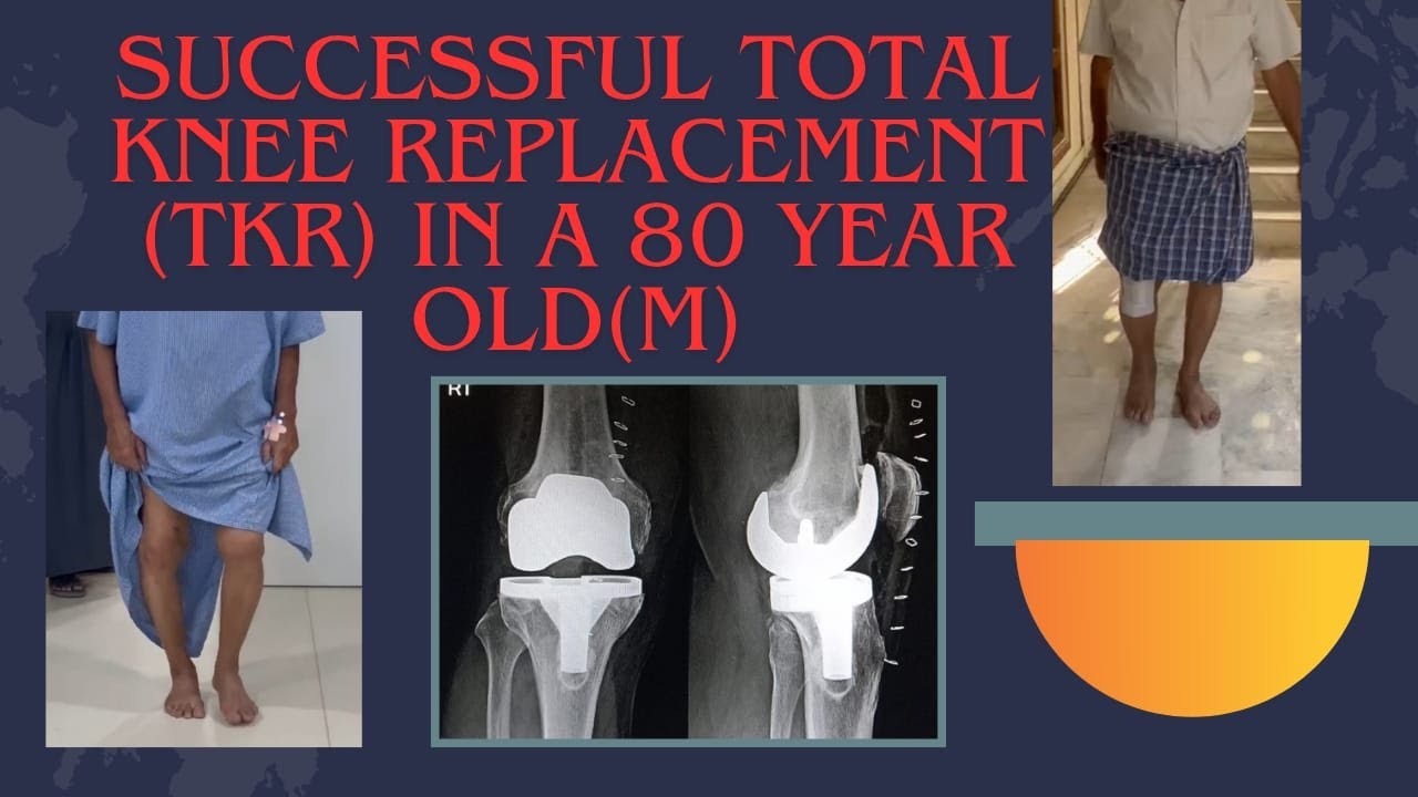 TOTAL KNEE REPLACEMENT WITH DEPUY PFC IN AN 80 YEAR OLD GENTLEMAN WITH ...