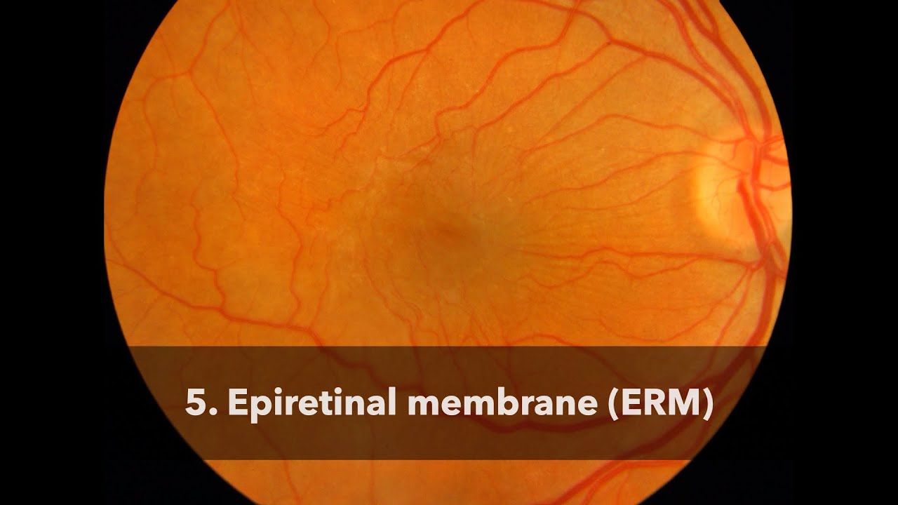 Epiretinal Membrane (ERM) - YouTube