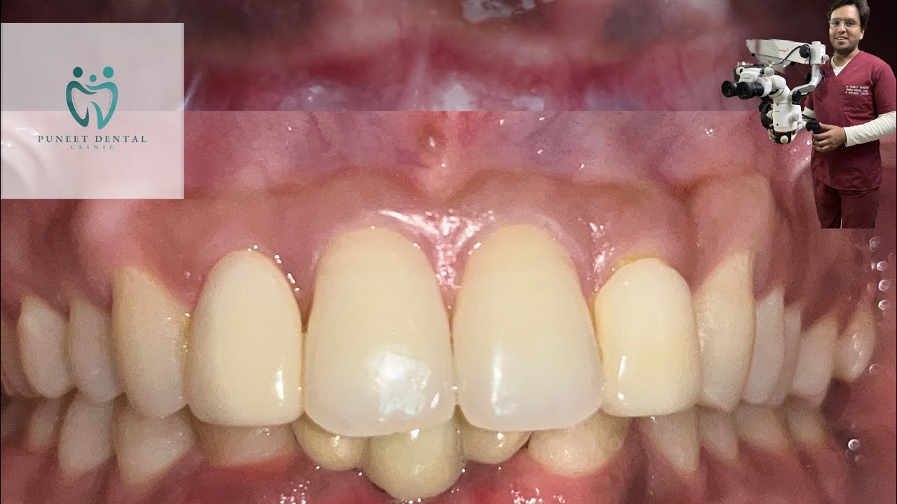 Smile design case with dental implants ,veneers and braces! - YouTube