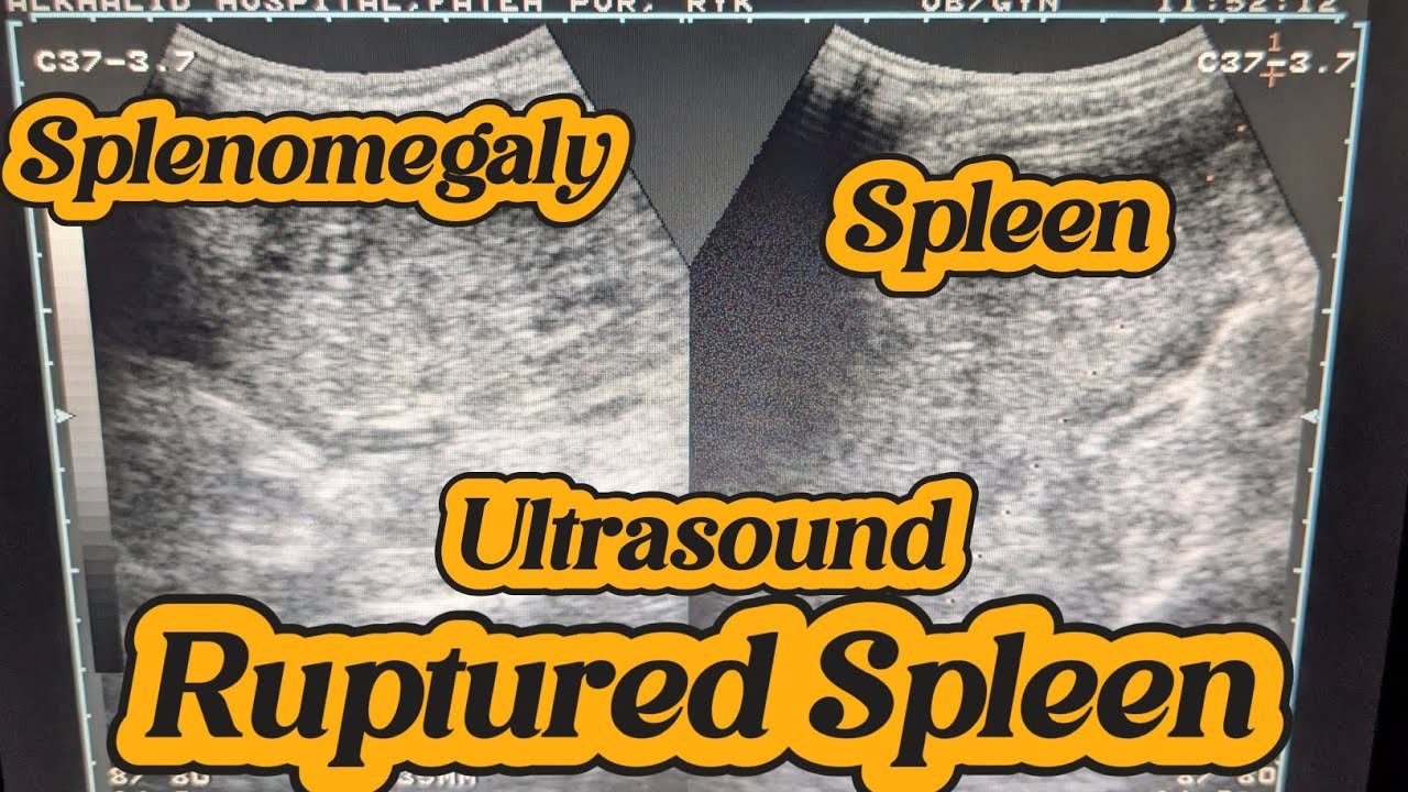 Ultrasound Video Spleen Rupture and Lacerations Lacerations | Ascites ...