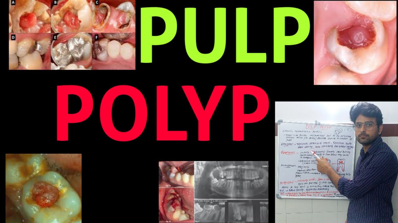 Pulp polyp - YouTube