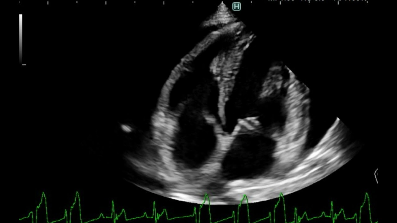 Echo image of the Cardiac tamponade in a dog with VPCs（VPCが発生している犬の心タンポ ...