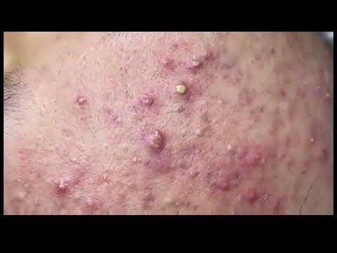 𝗘𝘅𝘁𝗿𝗲𝗺𝗲 𝗕𝗹𝗮𝗰𝗸𝗵𝗲𝗮𝗱 𝗥𝗲𝗺𝗼𝘃𝗮𝗹 𝗮𝘁 𝗡𝗔𝗦𝗔 𝗦𝗸𝗶𝗻 #acne #32761 #blackheads #pimple ...