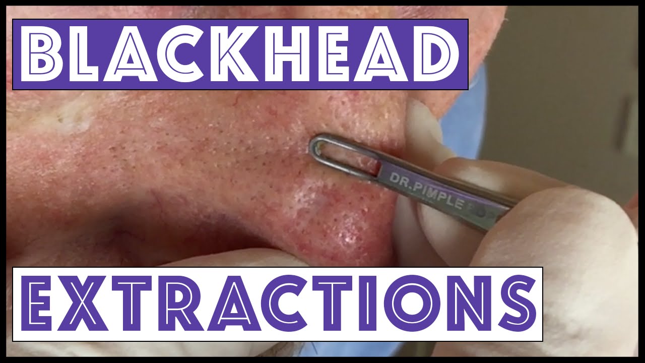 Blackheads Extracted After Mohs Surgery Youtube