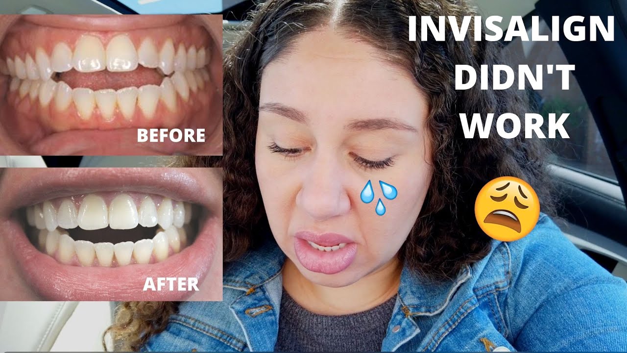 Adult Braces Invisalign Didnt Work Before And After During