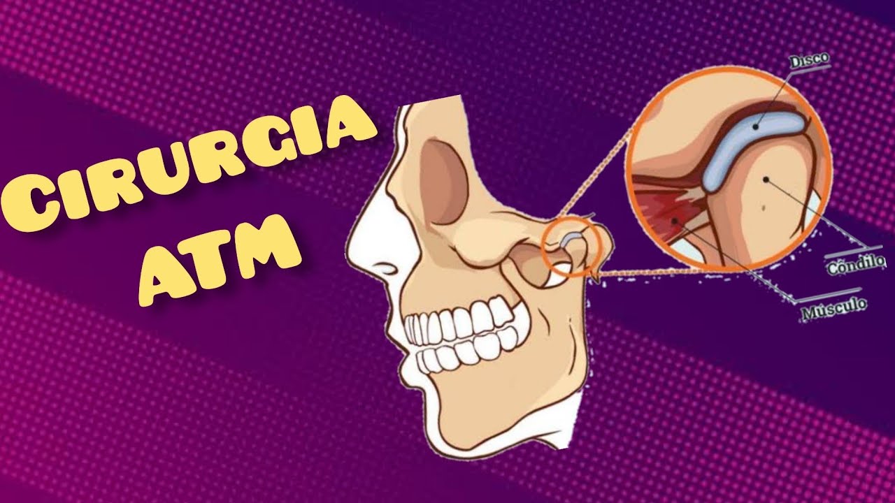 CIRURGIA DA ATM - MAXILAR DESGASTADO !!!! - YouTube