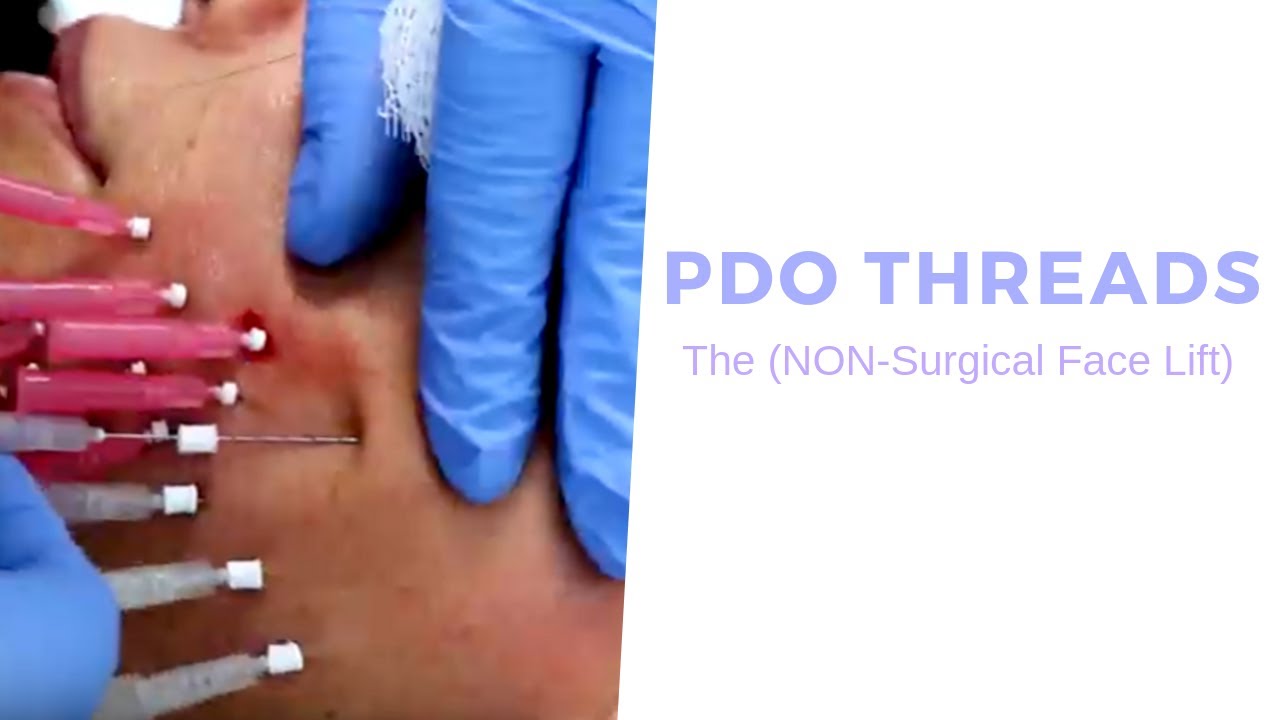 PDO THREADS - Tightens and Lifts - YouTube