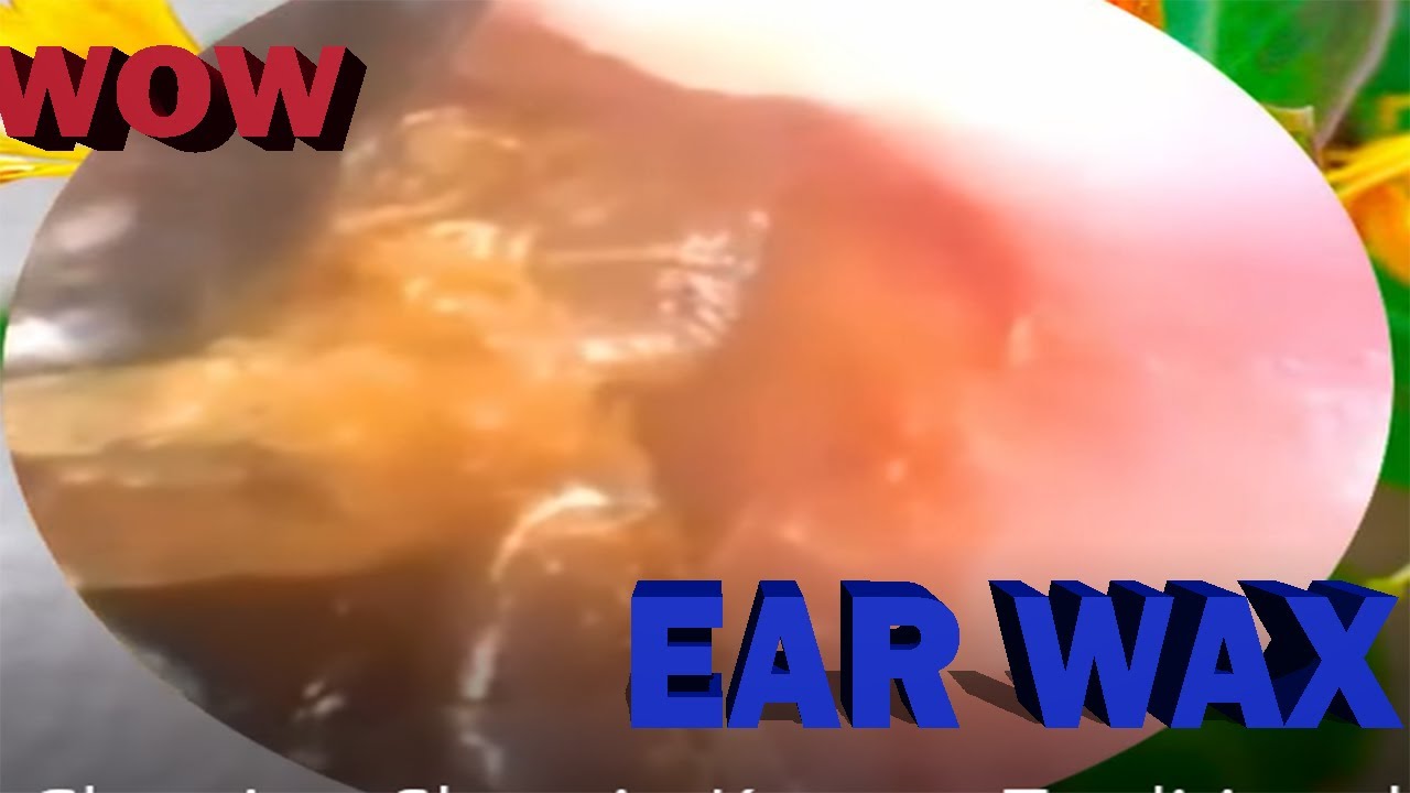 WAR WAX REMOVAL. Asmr -earwax blockage removal-EP#129 - YouTube