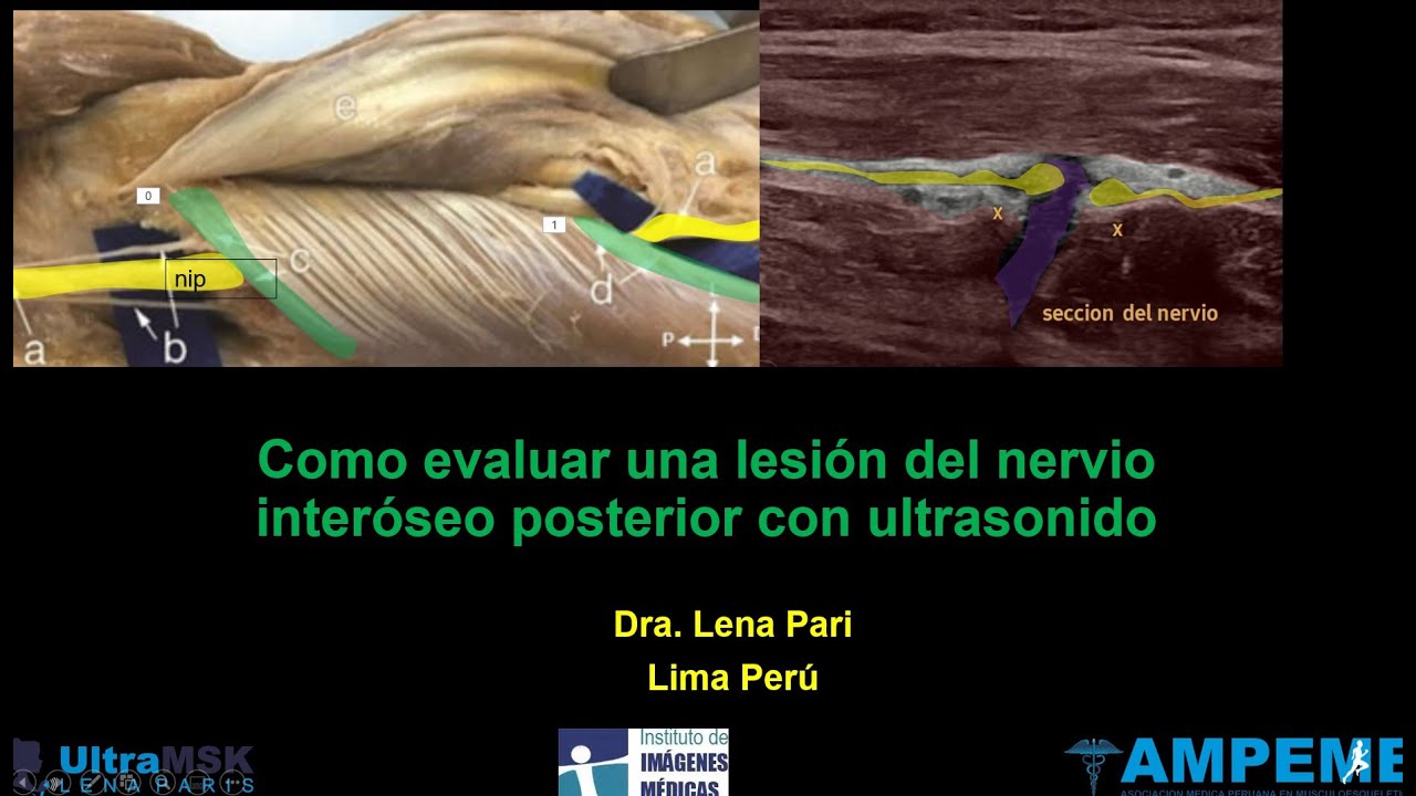 Como evaluar una lesión del nervio interóseo posterior en ultrasonido ...