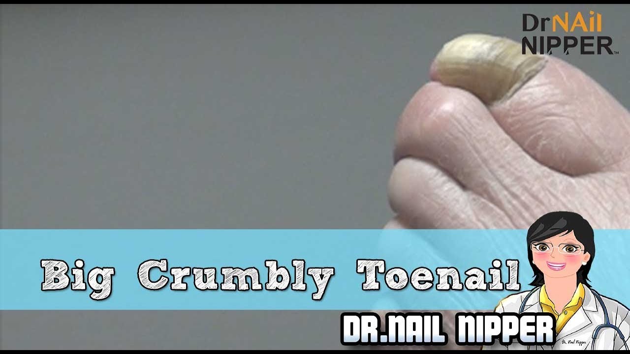 Big Crumbly Toenails - Dr. Nail Nipper - YouTube